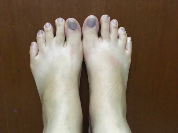 Claw toe causes, treatment and prevention - News Anyway
